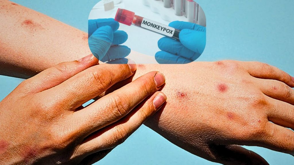 Understanding Mpox: Signs, Symptoms, & Treatment